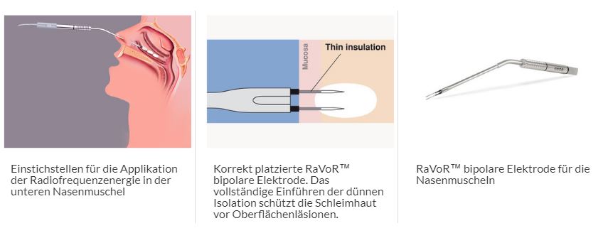 RaVoR Nasenmuschel-Sonde® 700462 Sutter Medizintechnik – Neuwirth ...