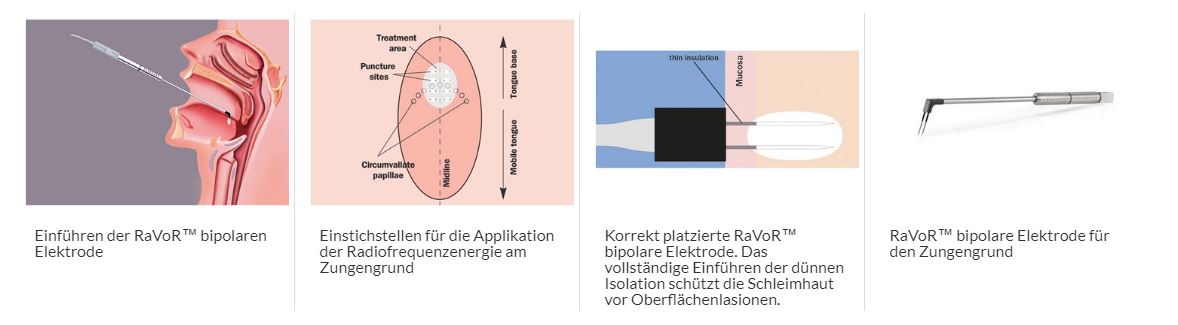 RaVoR Zungengrund-Sonde® 700499 Sutter Medizintechnik – Neuwirth ...